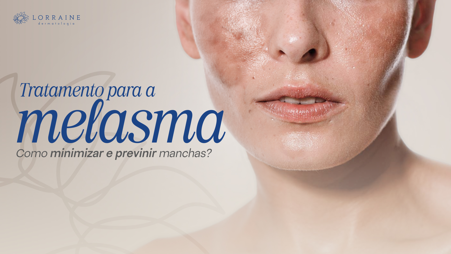 Tratamento para melasma: como minimizar e prevenir manchas? - Dra ...